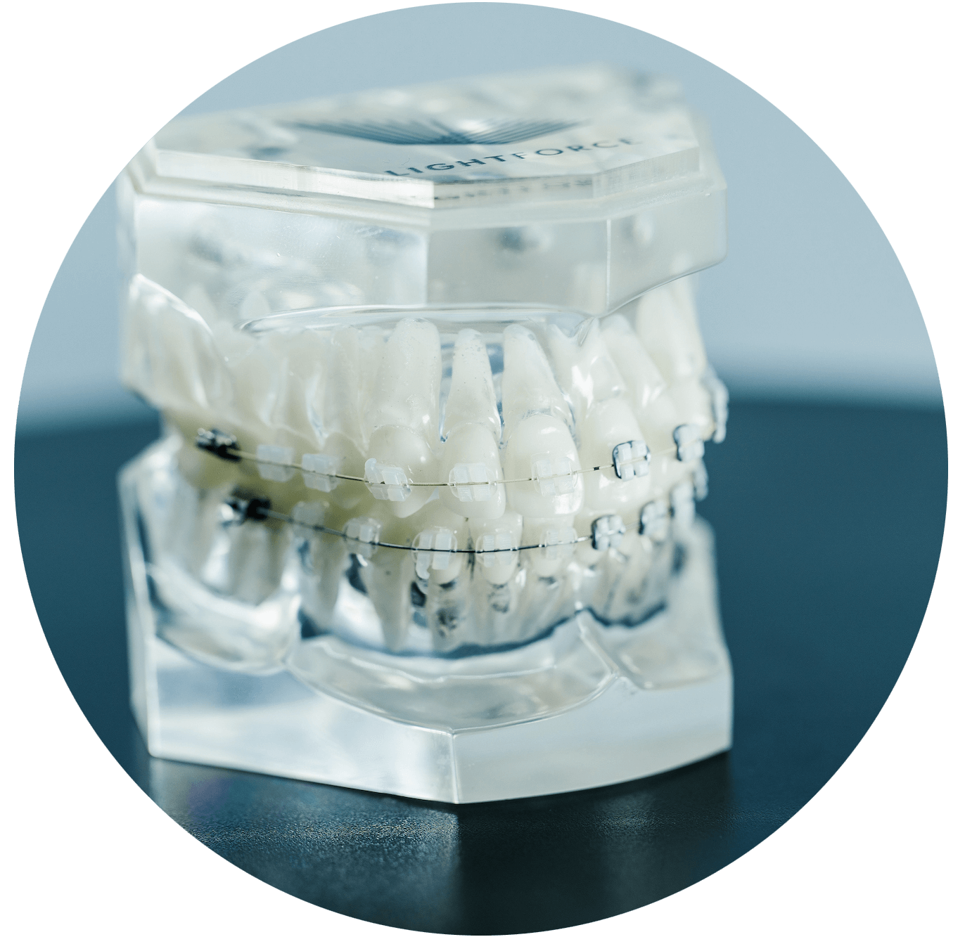LightForce Orthodontics: 3-D Printed Custom Braces | Blue Wave Orthodontics
